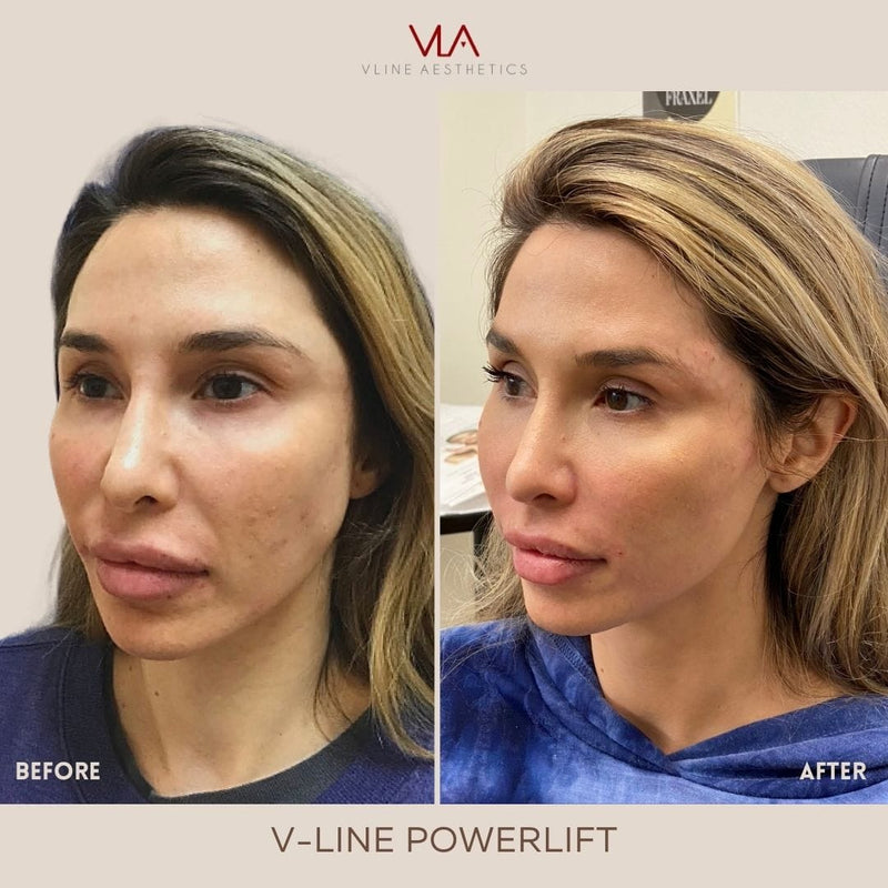 First Syringe of Jawline/V-Lift | Skin Perfect Brothers Powered by VLA