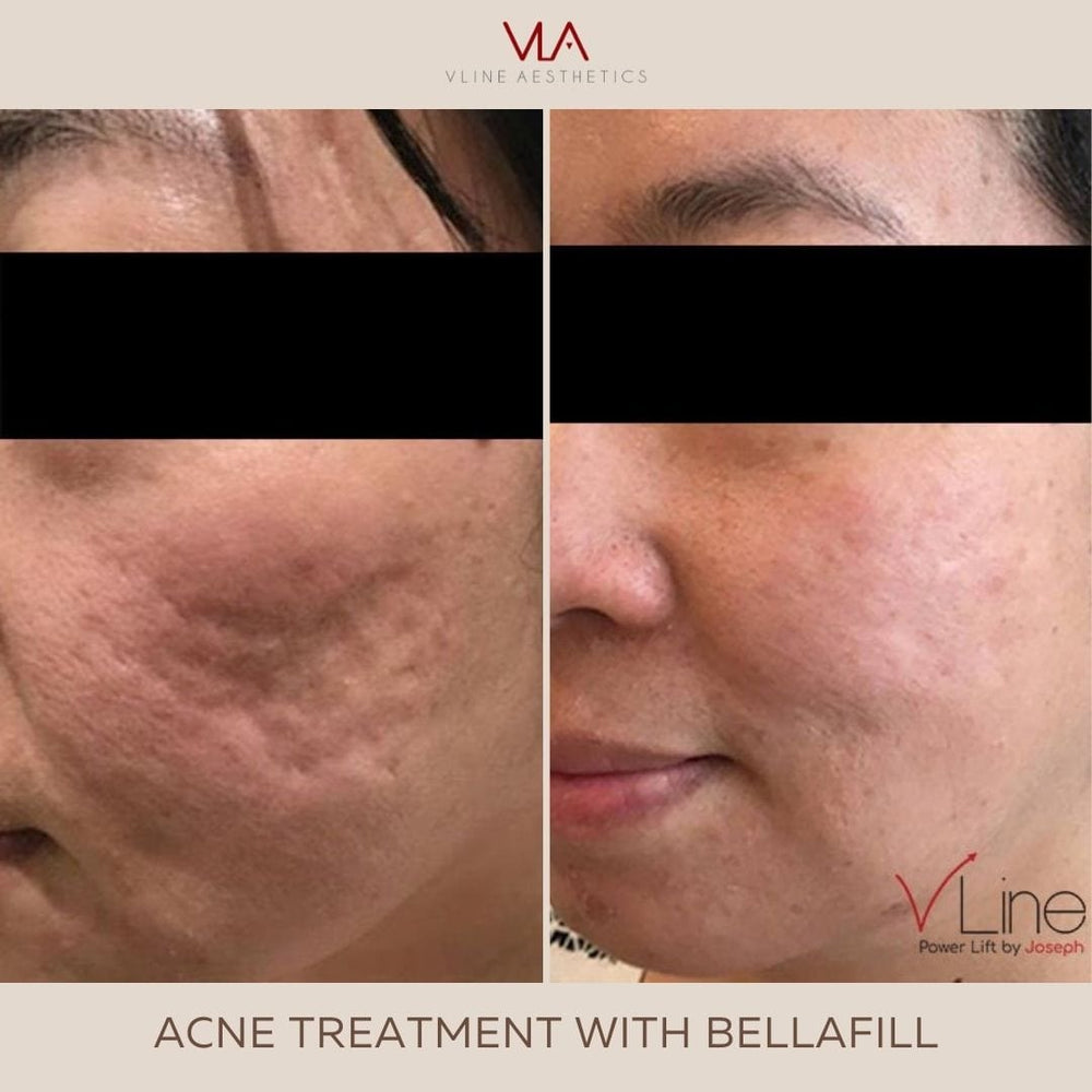 Acne Scars / 1 Bellafill | Skin Perfect Brothers Powered by VLA