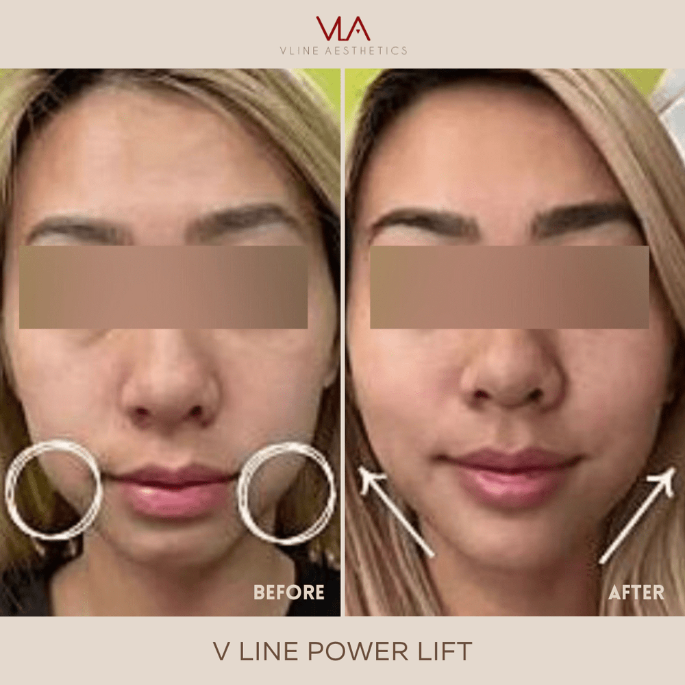 Chin Projection | Skin Perfect Brothers Powered by VLA